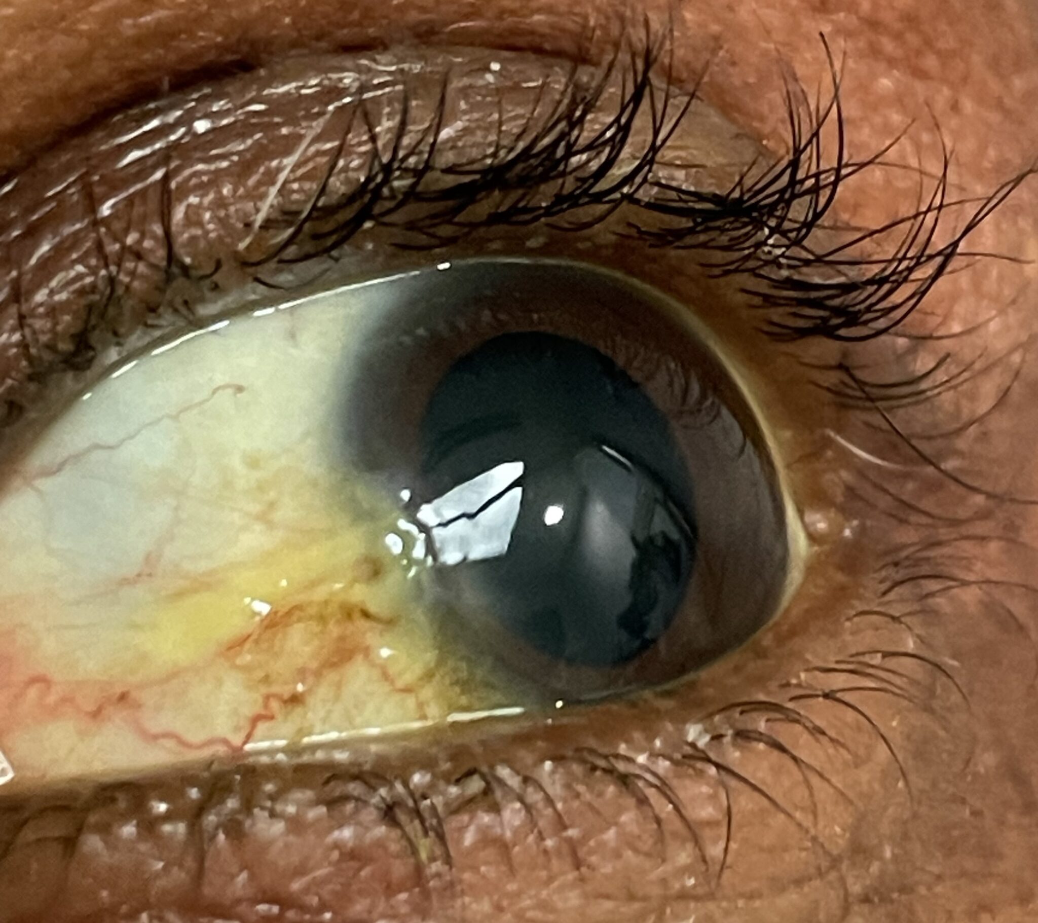 Comprehensive Board Certified Ophthalmologists | Pterygium